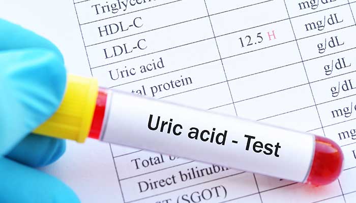 5 Ways to reduce uric acid naturally